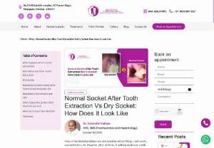 Normal Socket After Tooth Extraction Vs Dry Socket: How Does It Look ...